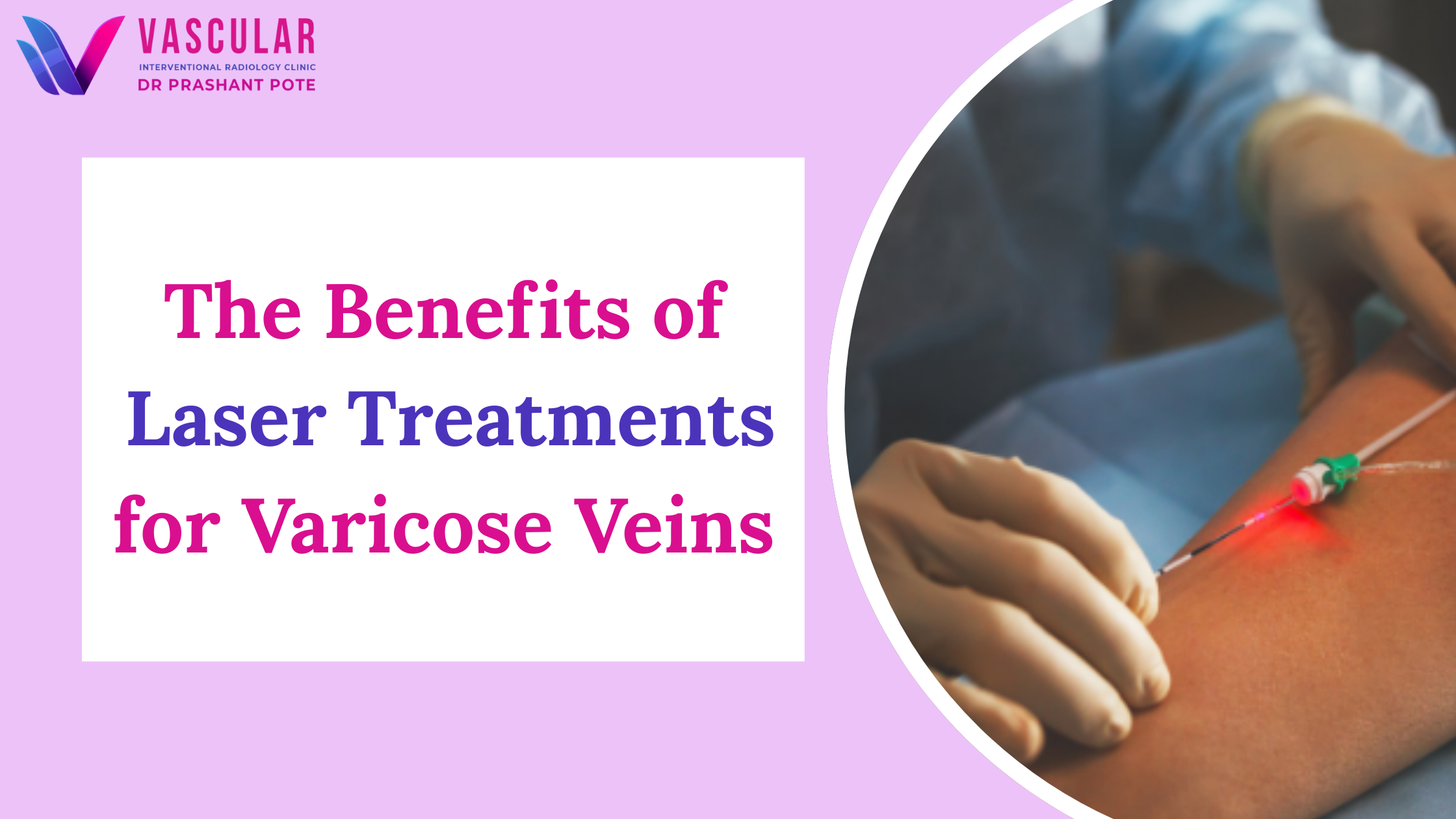 Benefits of Laser Treatment for Varicose Veins | Dr. Pote Vascular Clinic